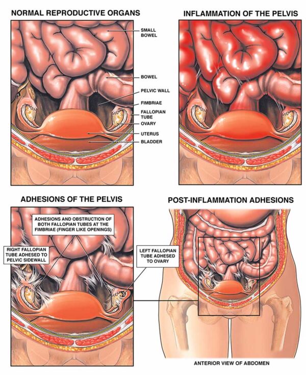 Abdominal Adhesions, (complications of surgery) can lead to chronic pain.